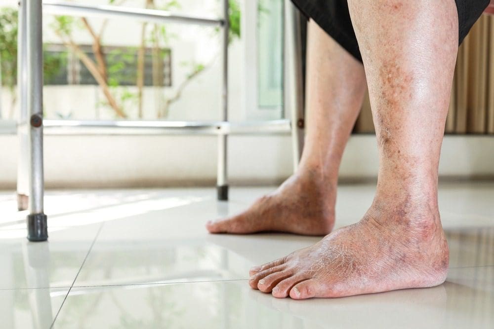 Stages of Venous Insufficiency - Signs, Causes & Treatments
